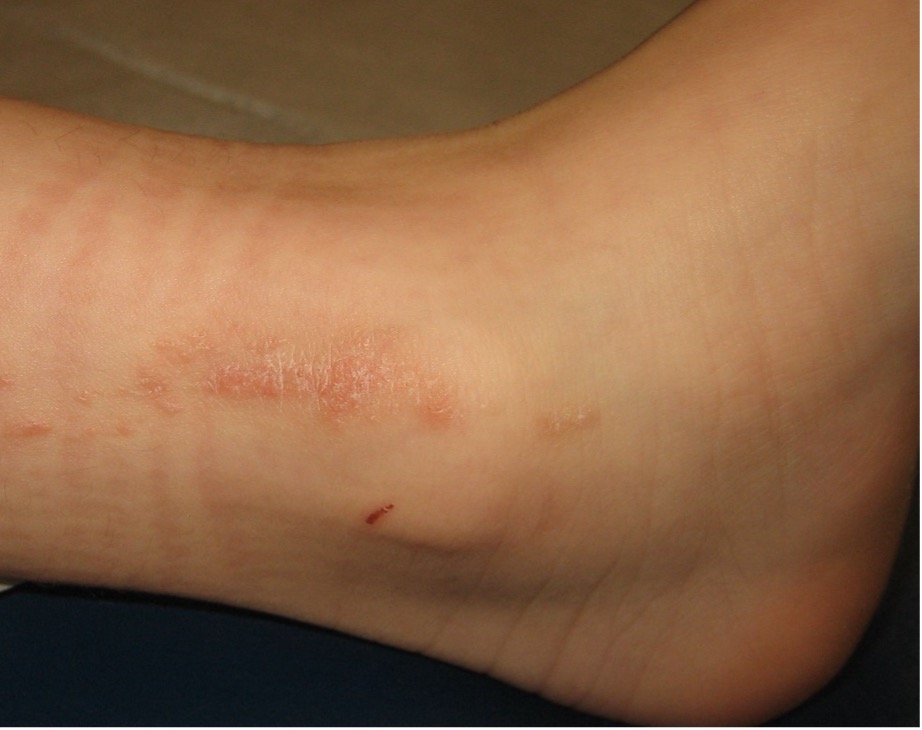 An Atlas of Lumps and Bumps, Part 38: Lichen Striatus | Consultant360